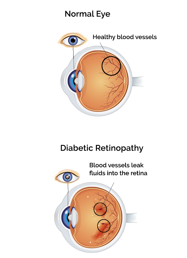 Diabetic Retinopathy Hannibal | International Eyecare Center - Hannibal